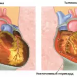 Viêm màng ngoài tim chấn thương: Tại sao có các triệu chứng, điều trị gia súc 6085_9